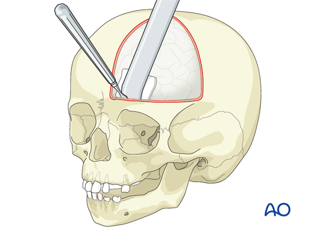 Optic nerve decompression with limited resection for Fibrous dysplasia ...