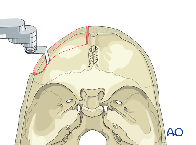 Optic nerve decompression with limited resection for Fibrous dysplasia ...