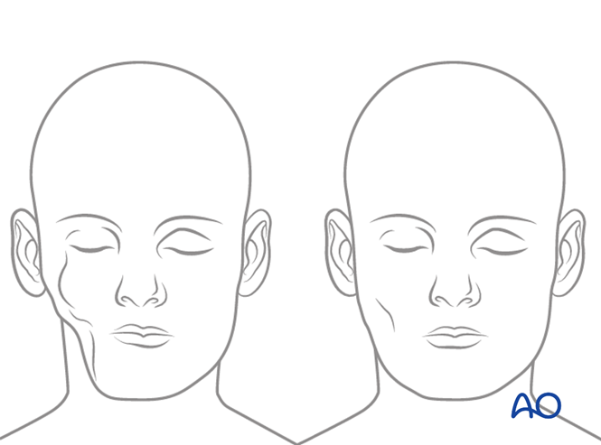 Fat grafting for soft tissue corrections