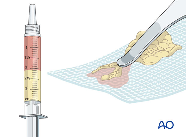 Fat grafting for soft tissue corrections