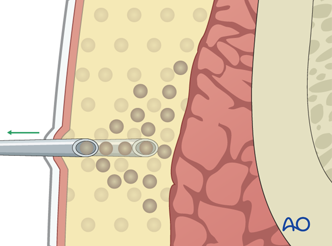 Fat grafting for soft tissue corrections