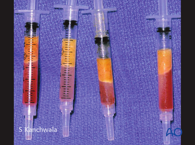 Fat grafting for soft tissue corrections