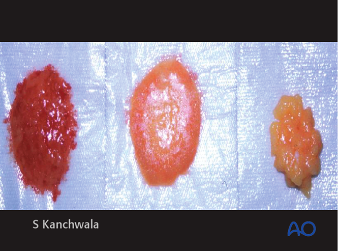 Fat grafting for soft tissue corrections