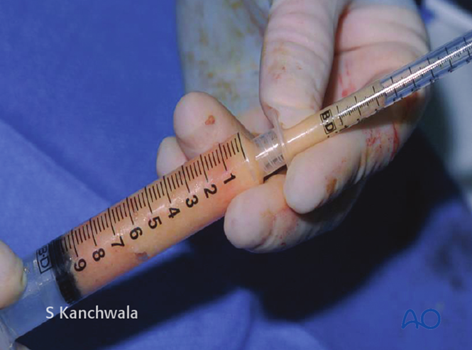 Fat grafting for soft tissue corrections