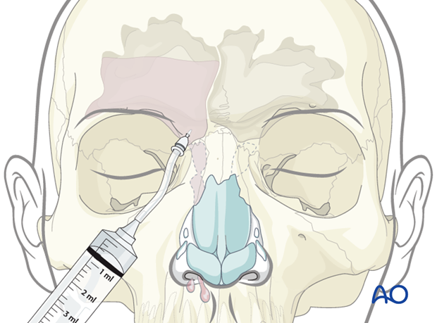 Endoscopically assisted transnasal drainage for Sinus outflow disease