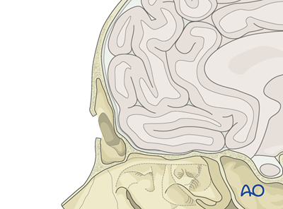 Frontal bone defects