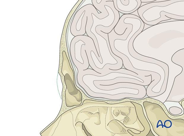 Frontal bone depression