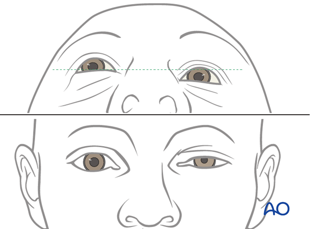 Orbital wall defects