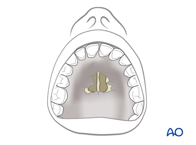 Oro-nasal/antral fistulae