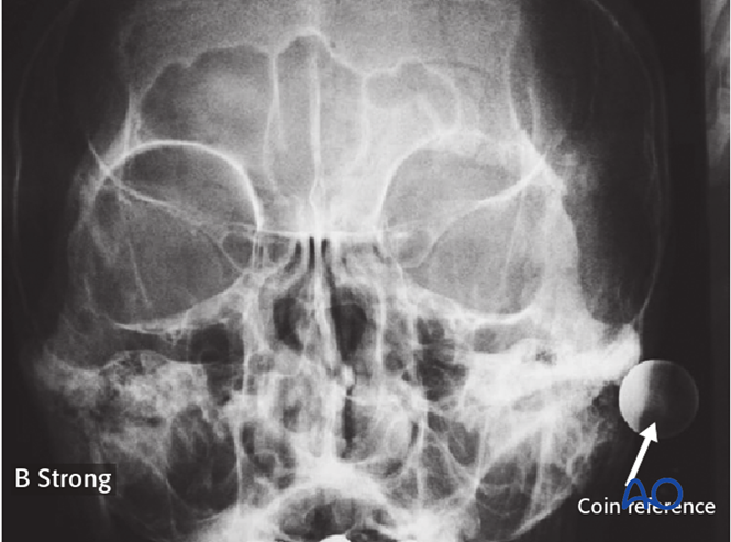 Cranialization for Sinus outflow disease