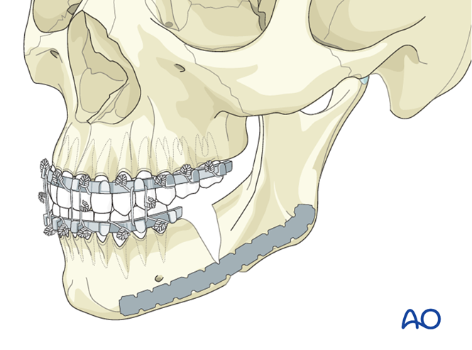 Debridement and internal fixation for Mandibular nonunion - Malocclusion
