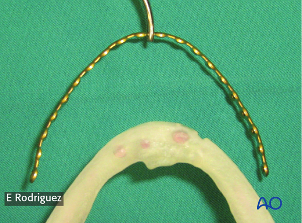 Osteotomy and internal fixation for Mandibular malunion - TMJ Dysfunction