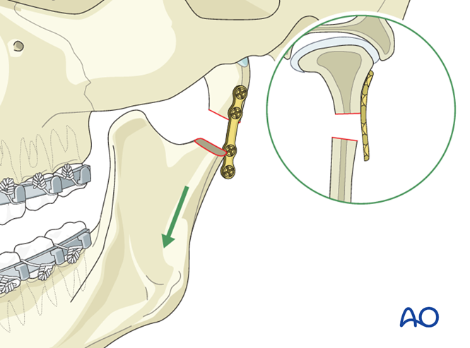 Osteotomy and internal fixation for Mandibular malunion - TMJ Dysfunction