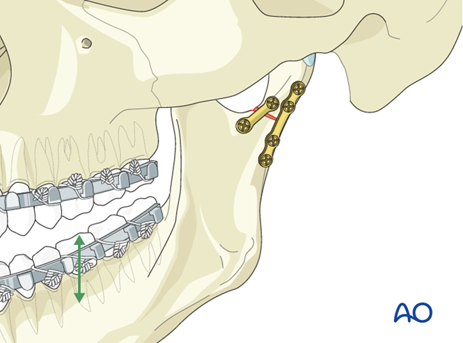 Osteotomy and internal fixation for Mandibular malunion - TMJ Dysfunction