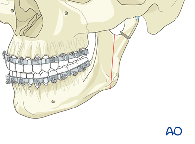 Orthognathic procedures for Mandibular nonunion - Malocclusion