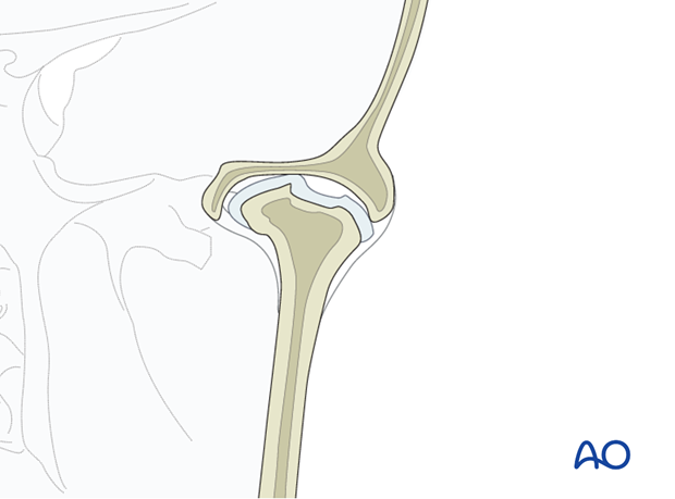 Condylar arthroplasty for Mandibular malunion - TMJ Dysfunction