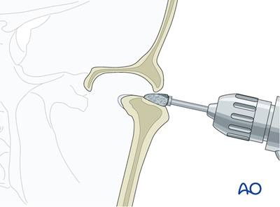 Condylar arthroplasty for Mandibular malunion - TMJ Dysfunction