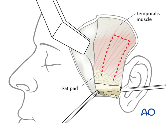 Gap arthroplasty for Mandibular malunion - TMJ Dysfunction