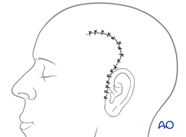 Gap arthroplasty for Mandibular malunion - TMJ Dysfunction
