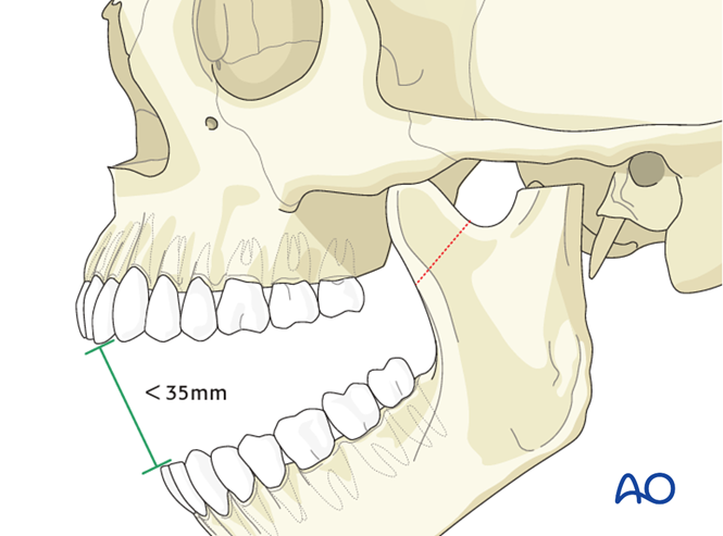 Gap arthroplasty for Mandibular malunion - TMJ Dysfunction