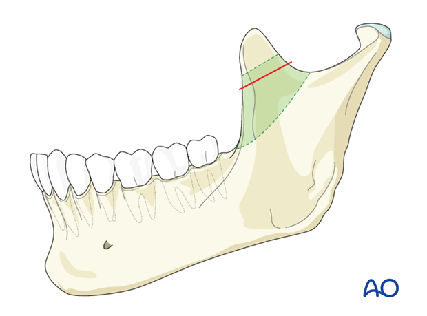 Gap arthroplasty for Mandibular malunion - TMJ Dysfunction