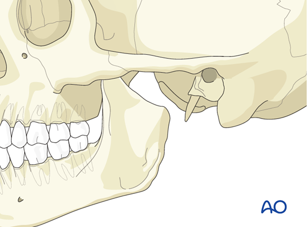 Condylar replacement - Autogenous for Mandibular nonunion - TMJ Dysfunction