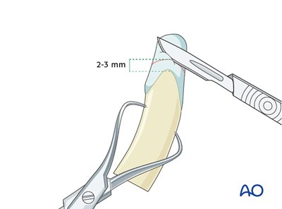 Condylar replacement - Autogenous for Mandibular nonunion - TMJ Dysfunction