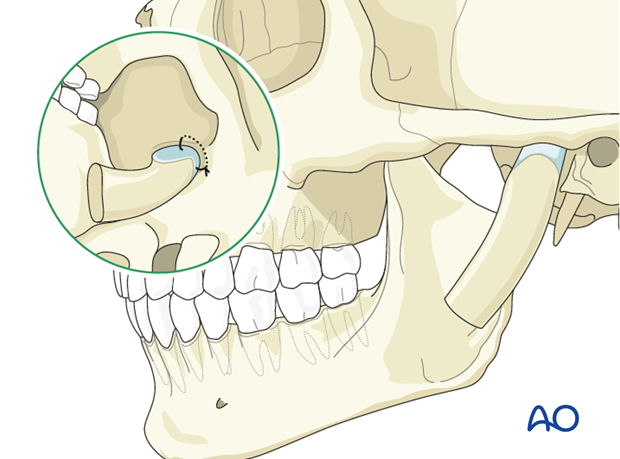 Condylar replacement - Autogenous for Mandibular nonunion - TMJ Dysfunction