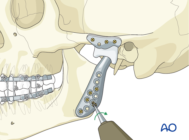 Condylar replacement - Autogenous for Mandibular nonunion - TMJ Dysfunction