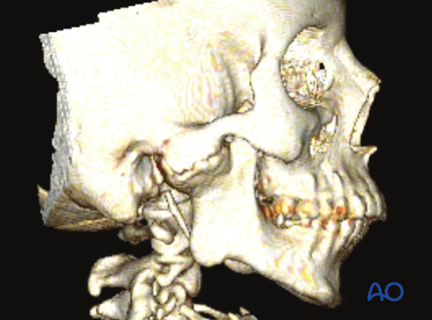 Arthroplasty and distraction osteogenesis for Mandibular hypomobility ...