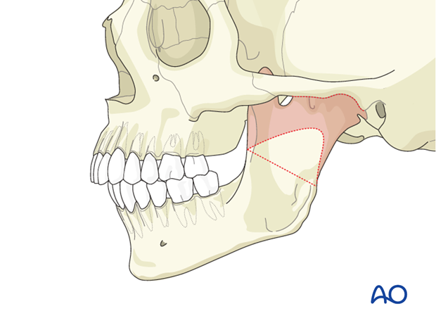 Arthroplasty and distraction osteogenesis for Mandibular hypomobility ...