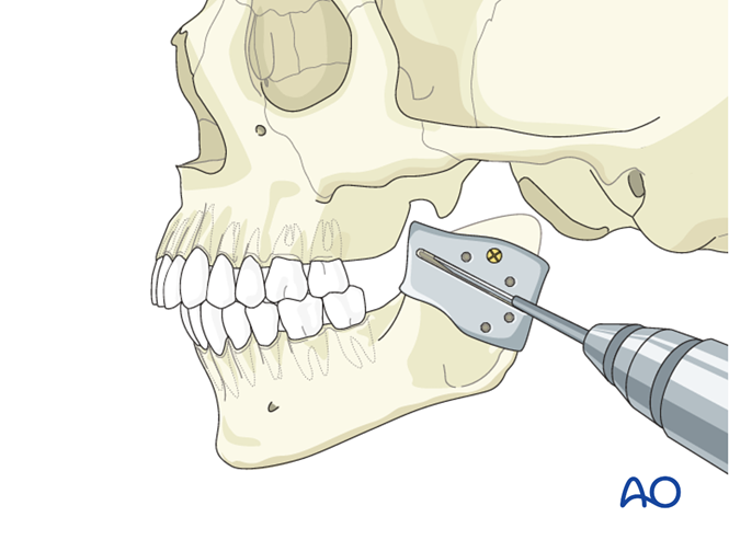Arthroplasty and distraction osteogenesis for Mandibular hypomobility ...