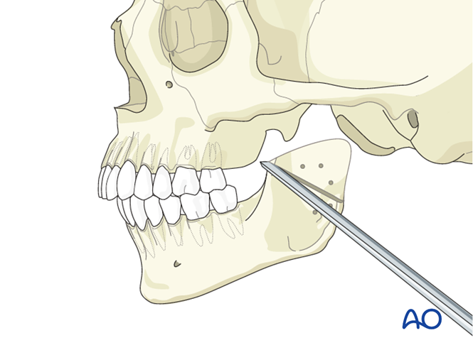 Arthroplasty and distraction osteogenesis for Mandibular hypomobility ...