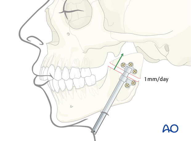 Arthroplasty and distraction osteogenesis for Mandibular hypomobility ...