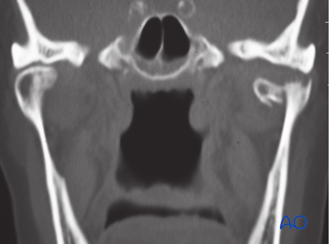 Condylectomy for Mandibular nonunion - TMJ Dysfunction