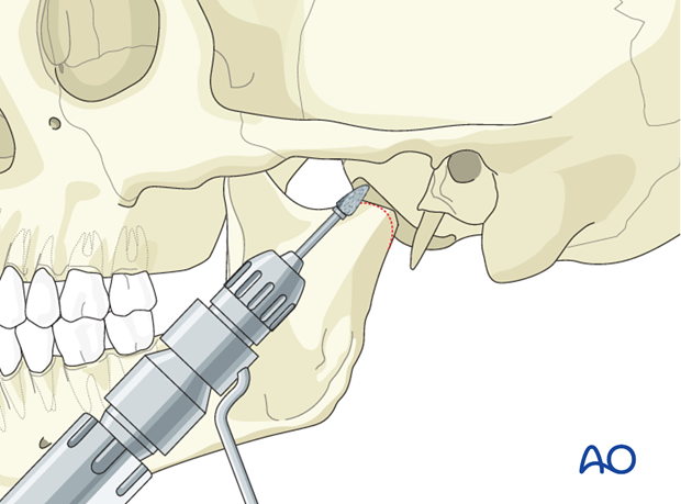 Condylectomy for Mandibular nonunion - TMJ Dysfunction