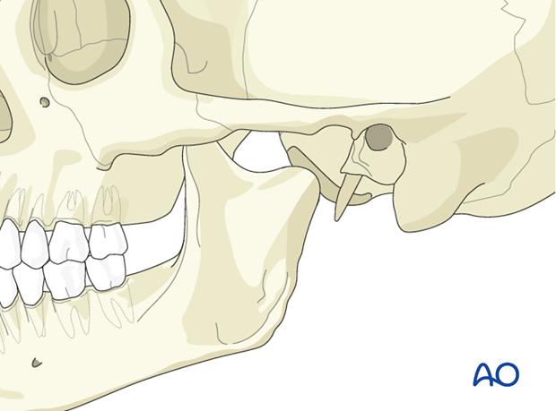 Condylectomy for Mandibular nonunion - TMJ Dysfunction