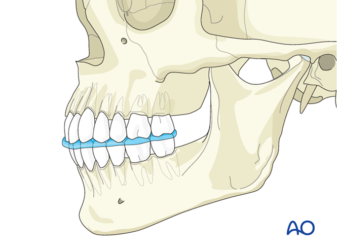 Mandible: TMJ Dysfunction