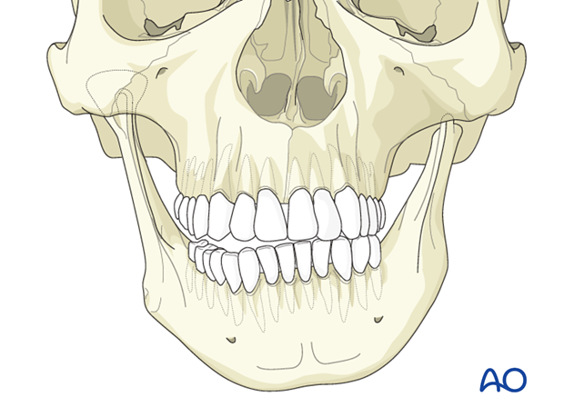 Distraction osteogenesis for Mandible - Facial asymmetry