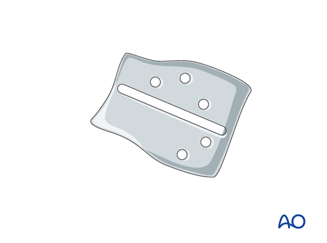 Distraction osteogenesis for Mandible - Facial asymmetry