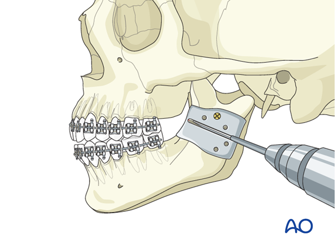 Distraction osteogenesis for Mandible - Facial asymmetry