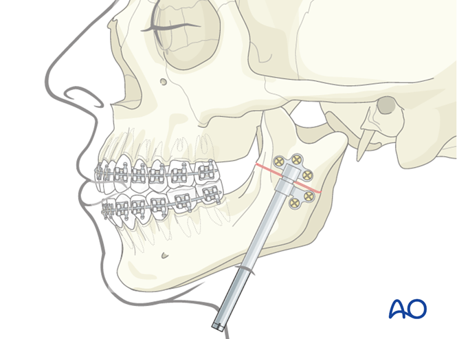 Distraction osteogenesis for Mandible - Facial asymmetry