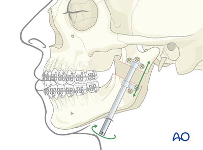 Distraction osteogenesis for Mandible - Facial asymmetry