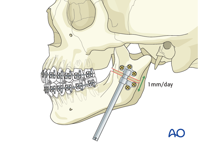 Distraction osteogenesis for Mandible - Facial asymmetry