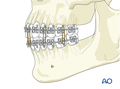 Functional therapy for Mandibular malunion - Malocclusion