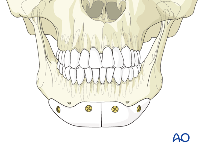 Augmentation procedures for Mandible - Facial asymmetry
