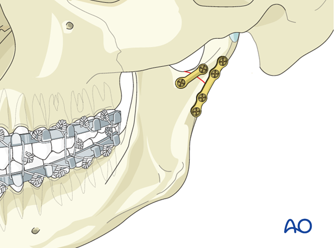 Debridement and internal fixation for Mandibular nonunion - TMJ Dysfunction