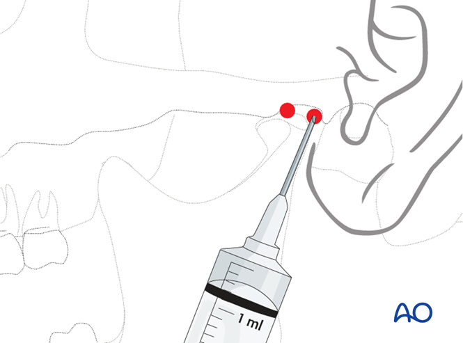 Arthrocentesis, discoplasty and discectomy