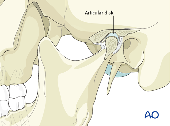 Arthrocentesis, discoplasty and discectomy