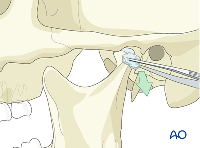 Arthrocentesis, discoplasty and discectomy